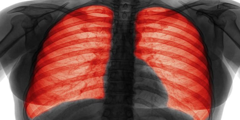 Enfisema Pulmonar: Causa, Sintomas e Tratamento | CliqueFarma