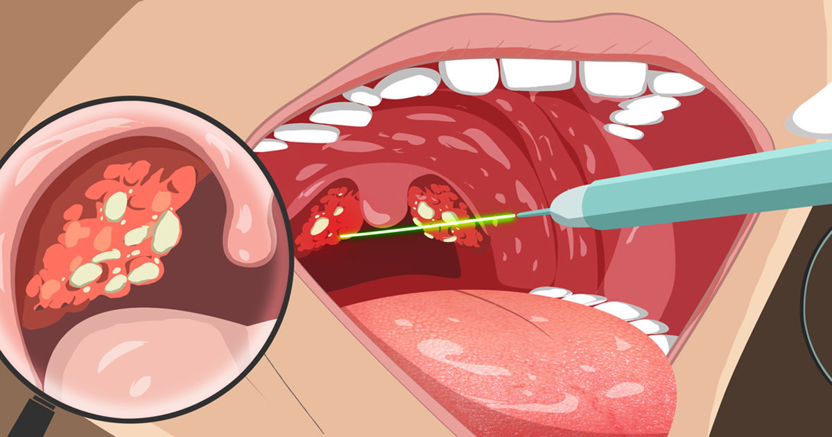 O que é Caseum? - Como tirar bolinhas brancas da garganta? | CliqueFarma